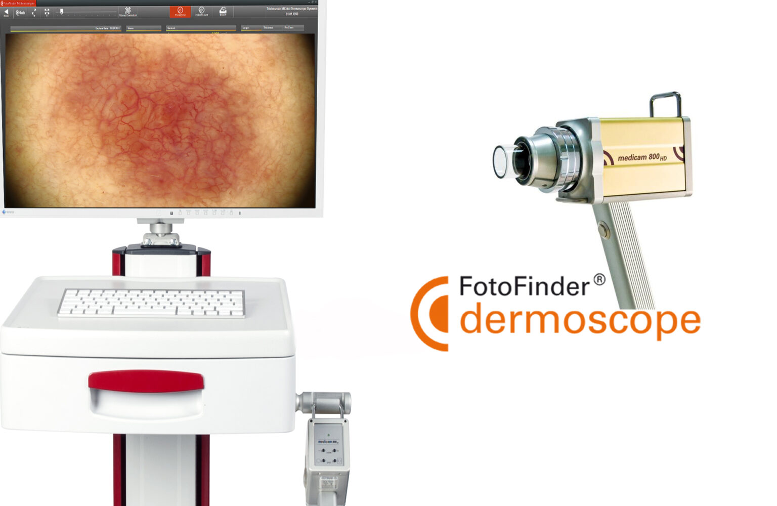 Fotofinder. lunares dermatoscopia digital - Lidia Pérez dermatólogos